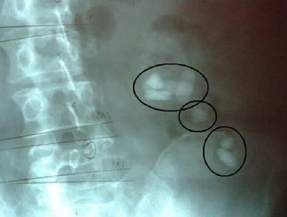 Katherine Knapp's Blog: Shocking X-Ray Photo of Undigested Vitamins!