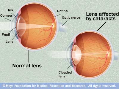 perceptionsense: Cataracts