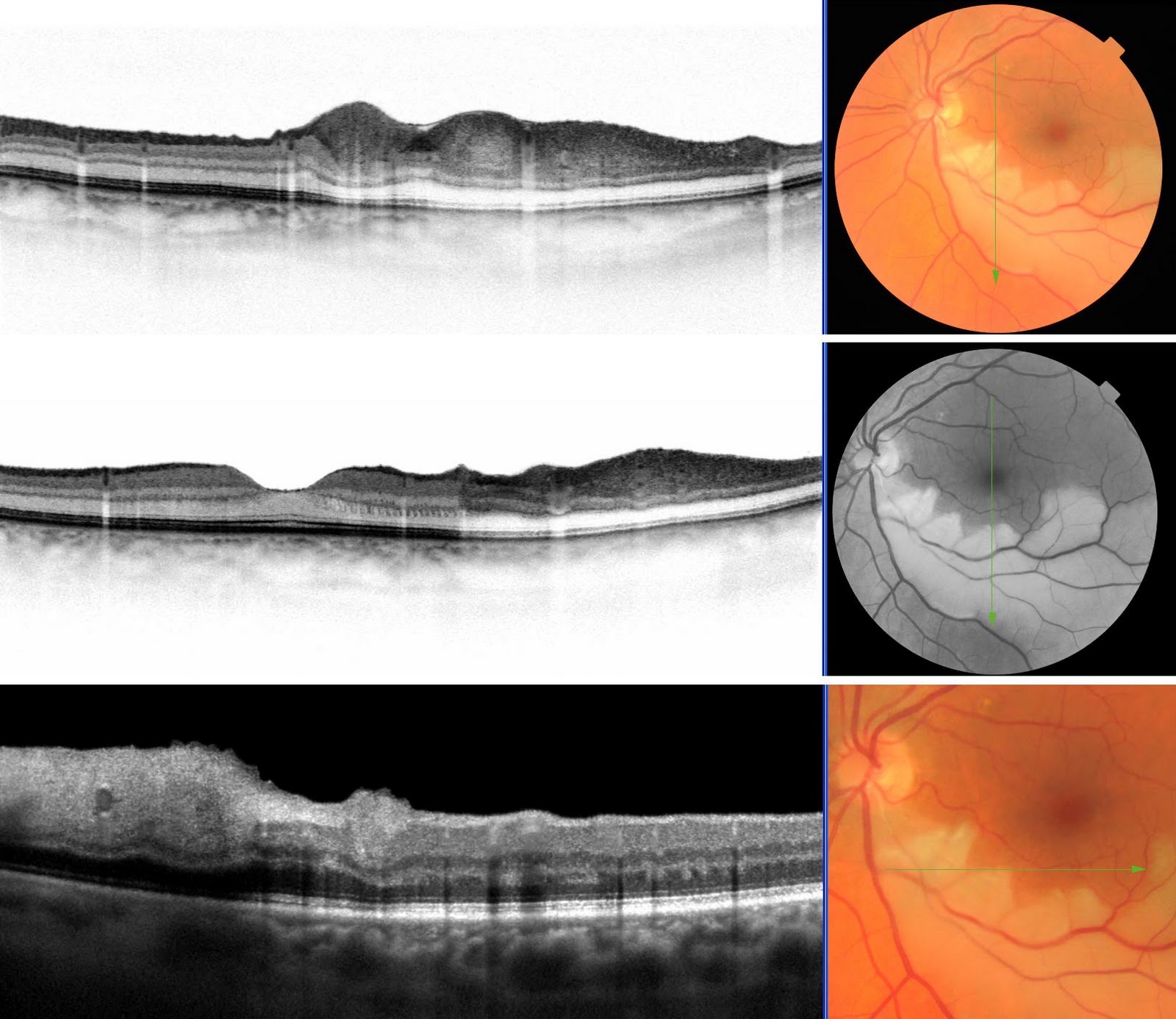Tomografía de Coherencia Óptica