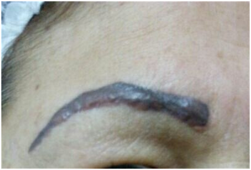 Cicatrización Queloide y la Micropigmentación - Romina De La Barrera