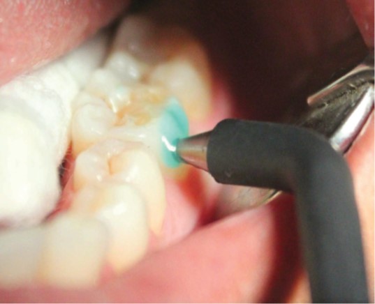 Pulp Vitality Tests with Classification and Recent Advances