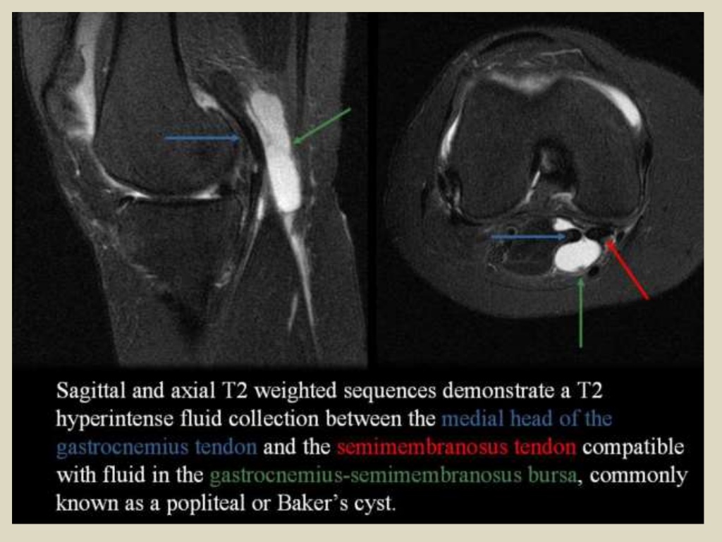 Mri Anatomy Of Knee Joint Radiology at Harrison Trethowan blog