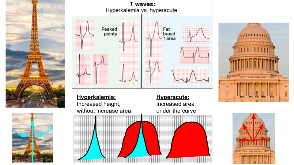Dr. Smith's ECG Blog: Teaching Images