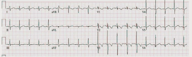 Dr. Smith's ECG Blog: April 2017