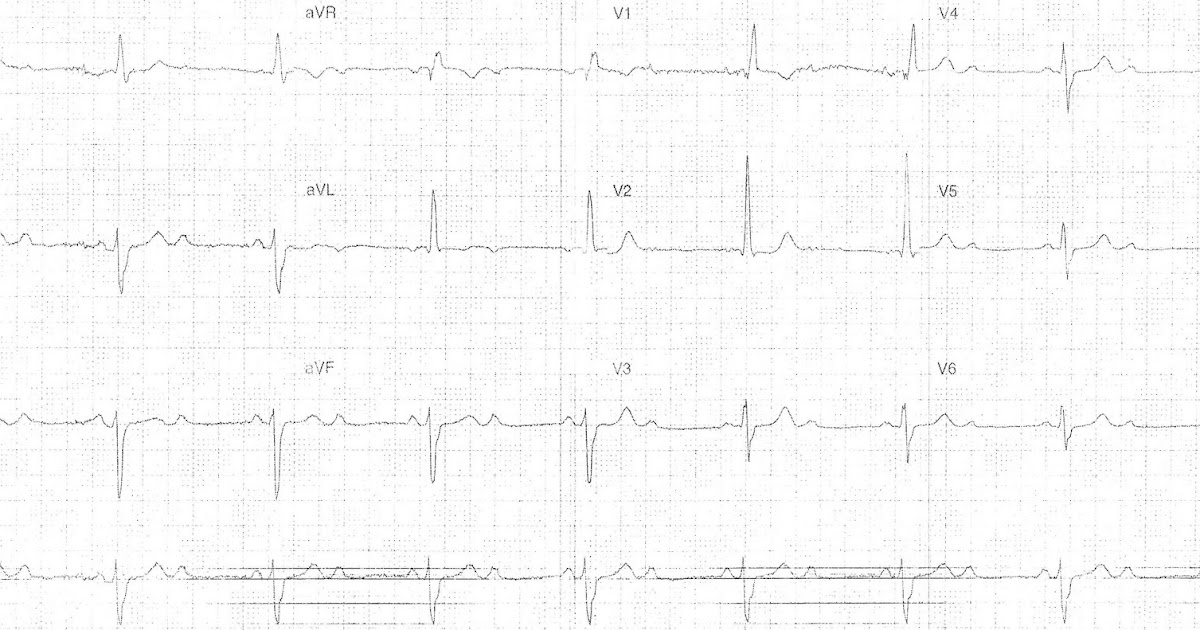 ECG of the Week: ECG of the Week - 29th October 2018