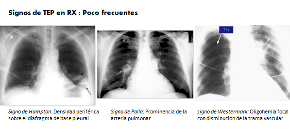 ESPE 202 - 2014: Caso clínico: TEP