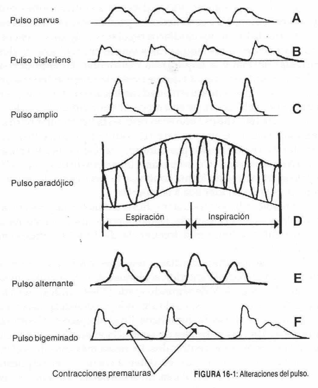 Tipos de alteraciones del pulso: Tipos de alteraciones del pulso:
