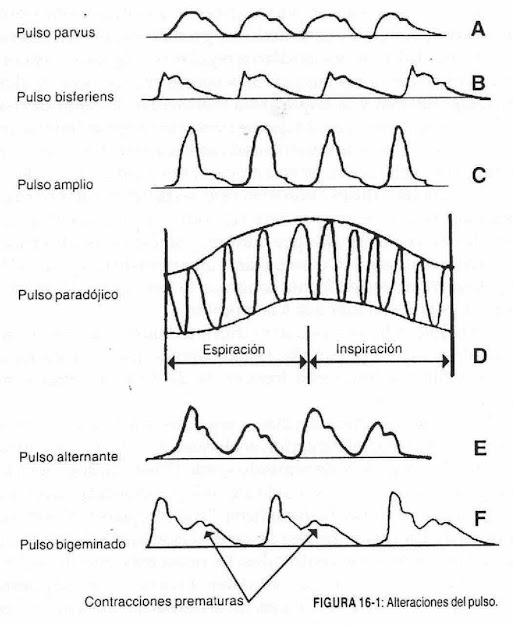 Tipos de alteraciones del pulso: