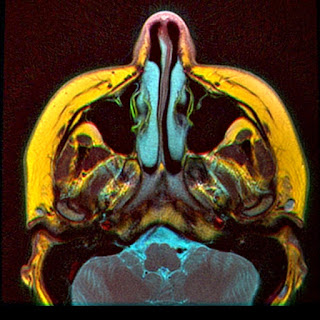 Nevit's blog: Color MRI of Orbita