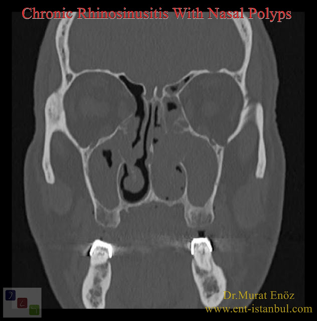 Nasal Polyp - Definition, Symptoms, Diagnosis and Treatment