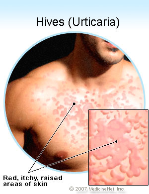 Redefining the Face Of Beauty : SKIN DISORDERS: HIVES & What to do?