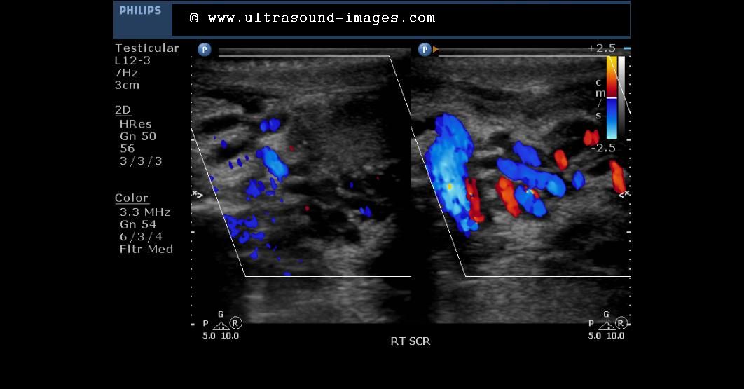 Varicocele- Reproductive system disease - List | Diigo