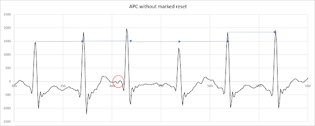 Muscle Oxygen Training: ECG Arrythmia/Artifact visualization - some tips