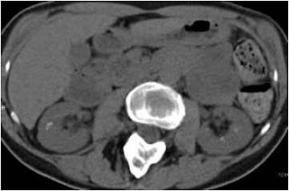 Radiologist For Ever: Renal rule 14 : Medullary sponge kidney