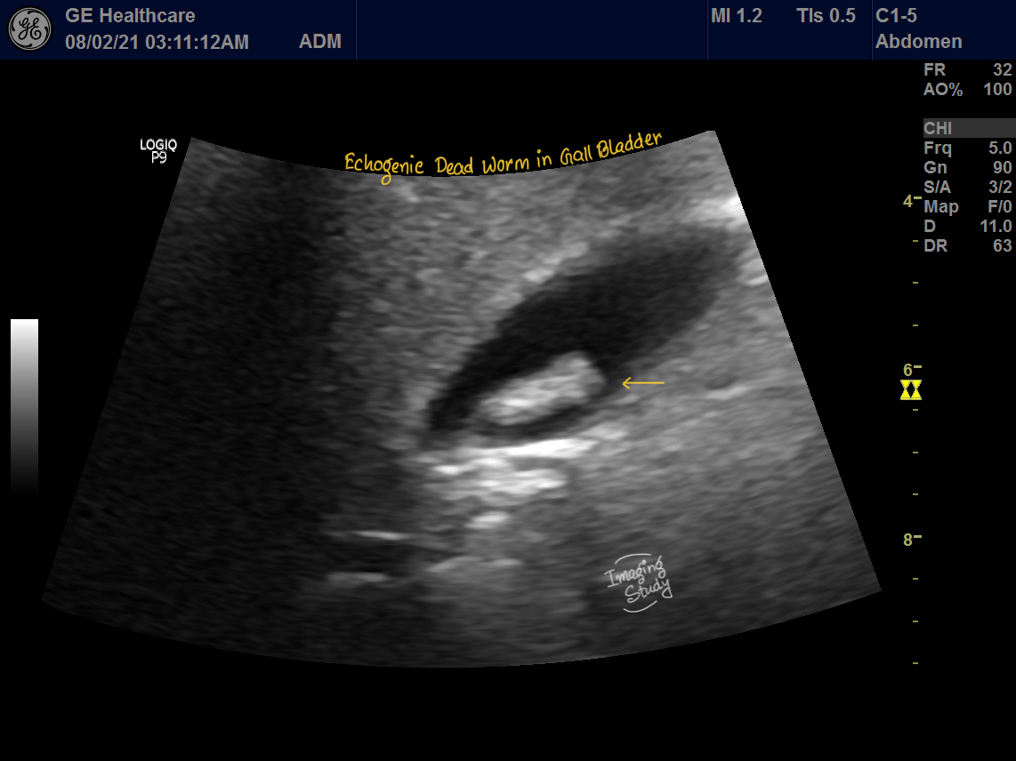 Case 31: Worm in Gallbladder - Biliary Ascariasis ~ Imaging Study