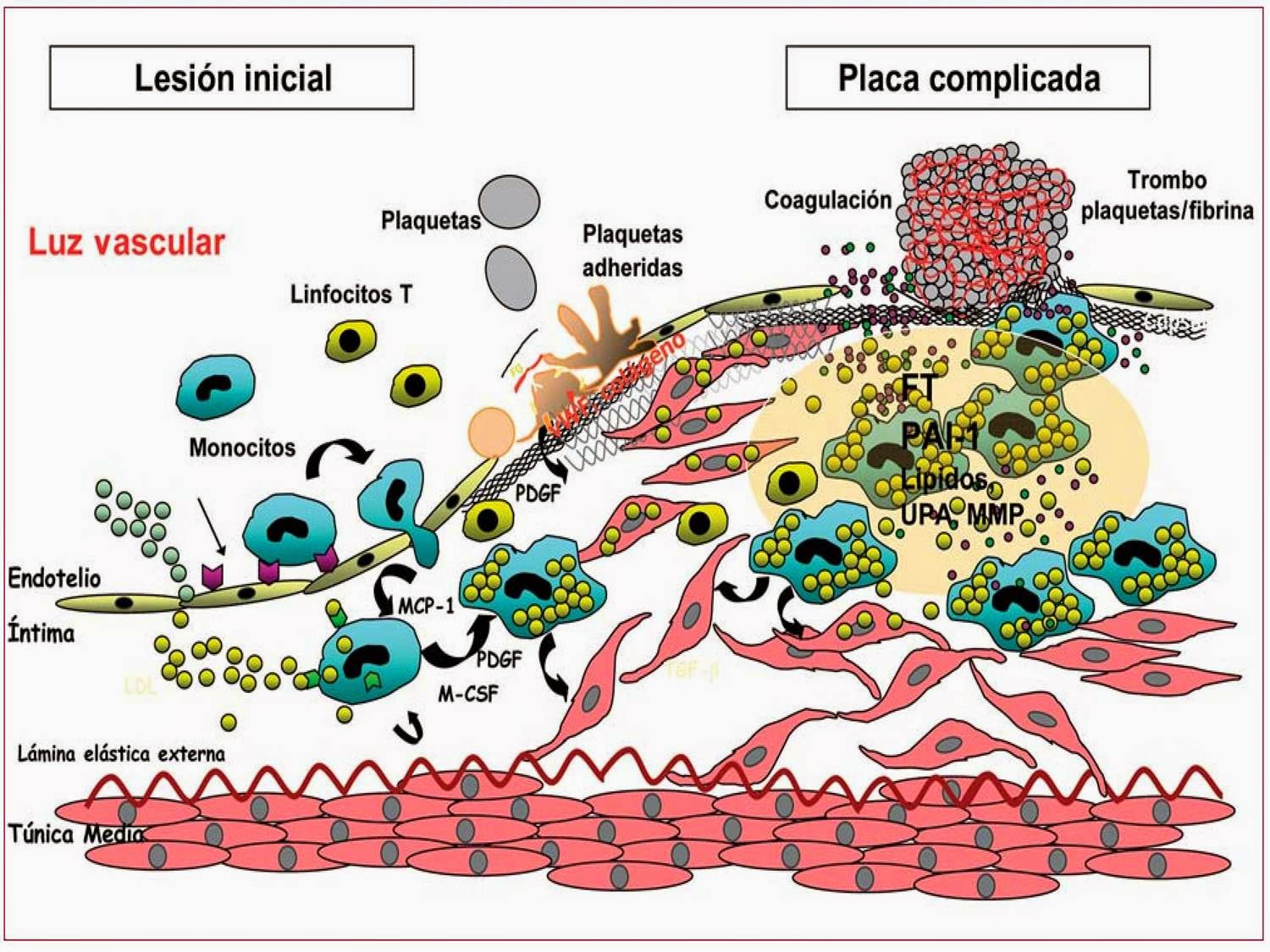 Oye montes .. : LOS ATEROMAS AFECTAN SEVERAMENTE AL CORAZÓN Y LAS ...