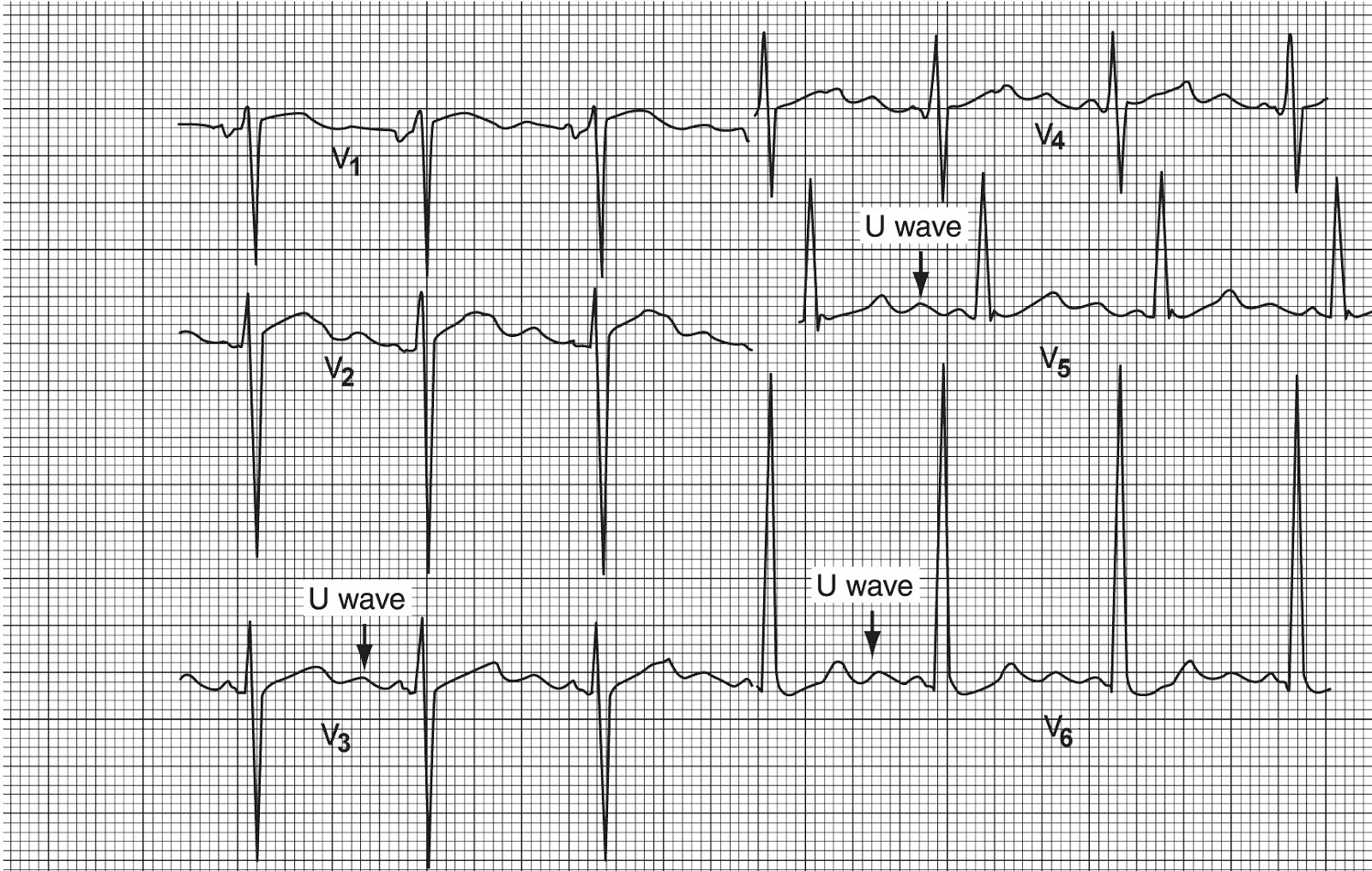 U Wave Ecg U Wave • LITFL Medical Blog • ECG Library Basics