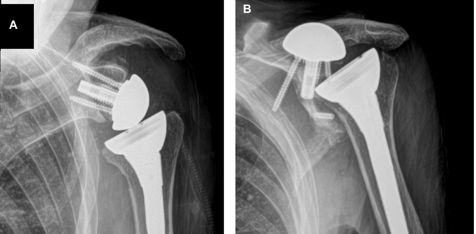 UW Shoulder and Elbow Academy: Reverse total shoulder - how durable are ...