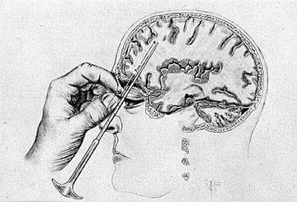 La locura de la "Lobotomía"