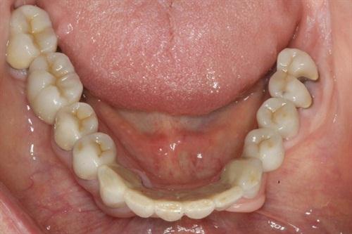 Biological shaping and barrel flute of crown - Bauer Smiles