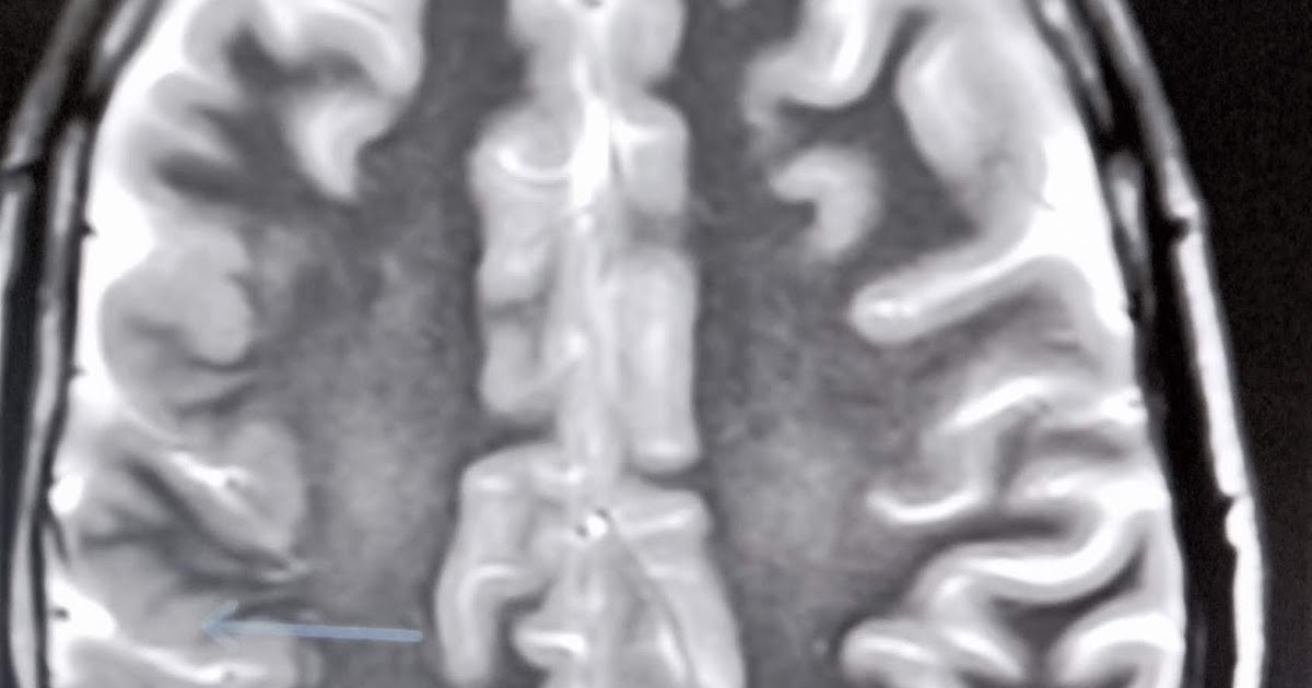 Polymicrogyria : MRI Teaching Case - Sumer's Radiology Blog