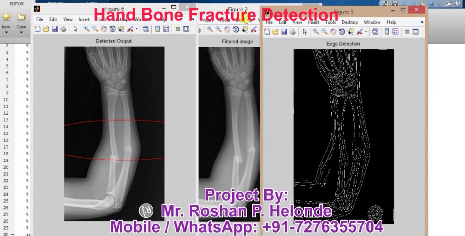 Hand Bone Fracture Detection using Image Processing Matlab Project with ...