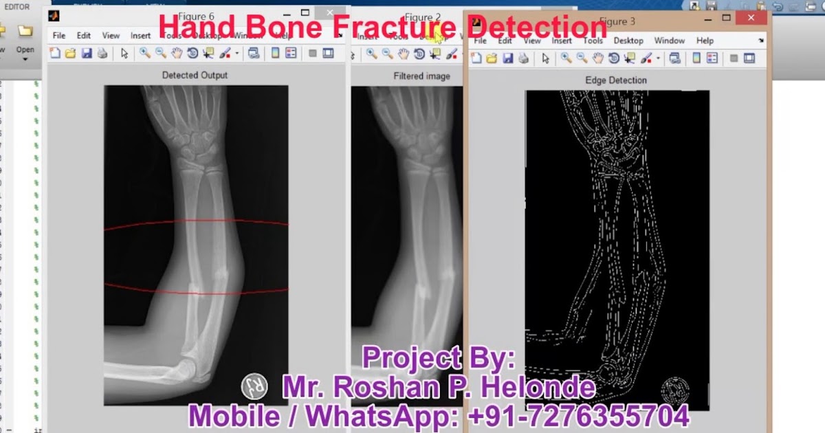 Hand Bone Fracture Detection using Image Processing Matlab Project with ...