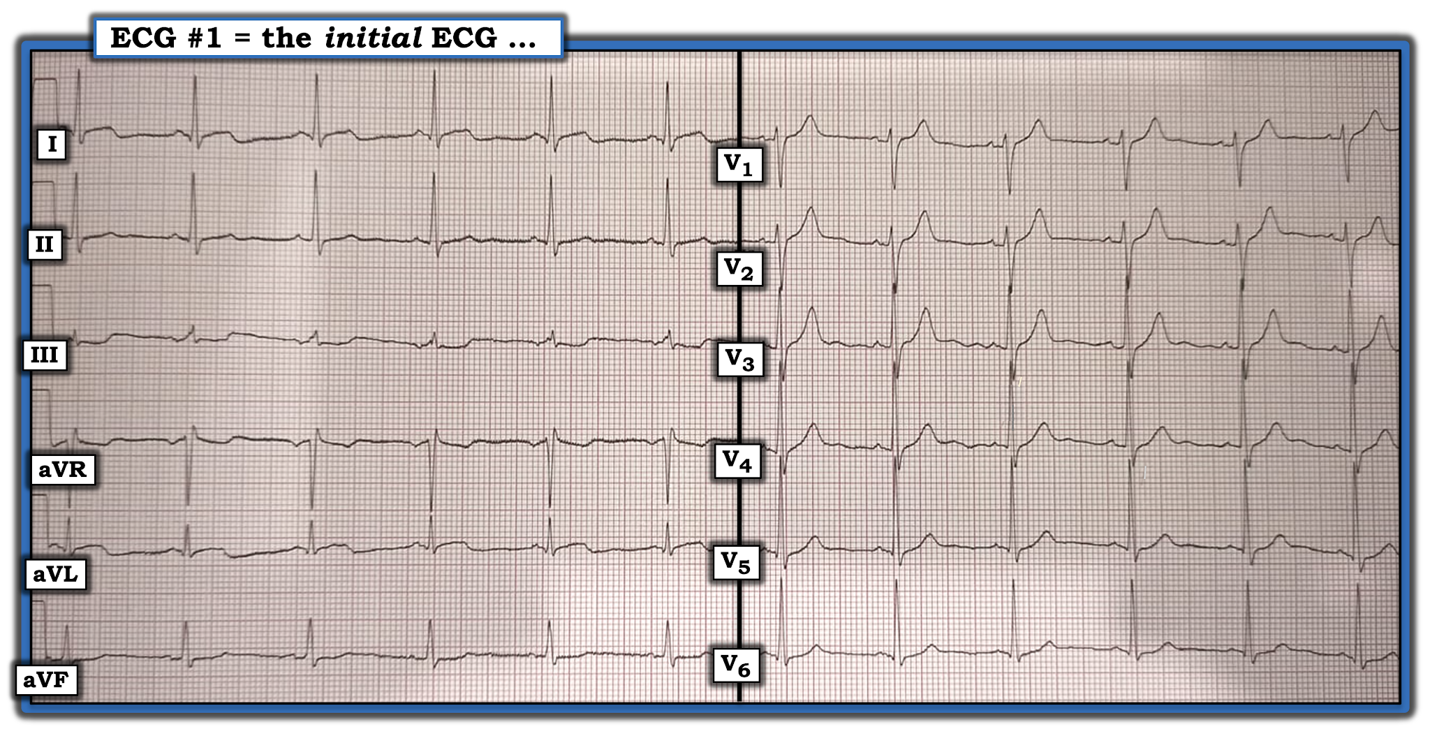 Myocarditis Ecg Changes