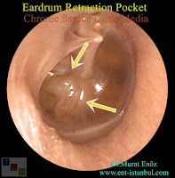 Retracted Eardrum - Definition, Symptoms, Causes and Treatment