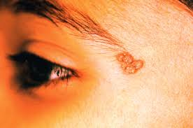 How To Remove Warts On Face - Moles, Warts & Skin Tags Removal