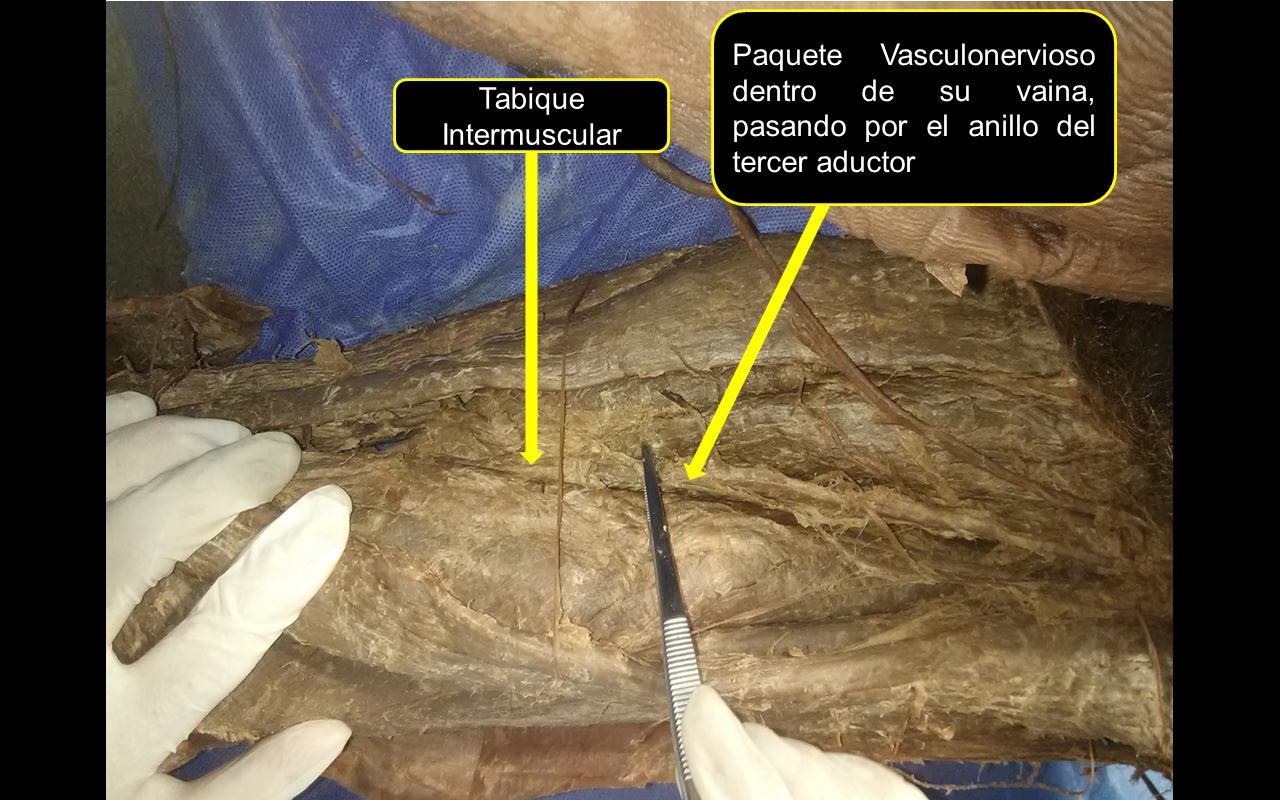 Disección de Muslo Ventromedial - Medicina Valera
