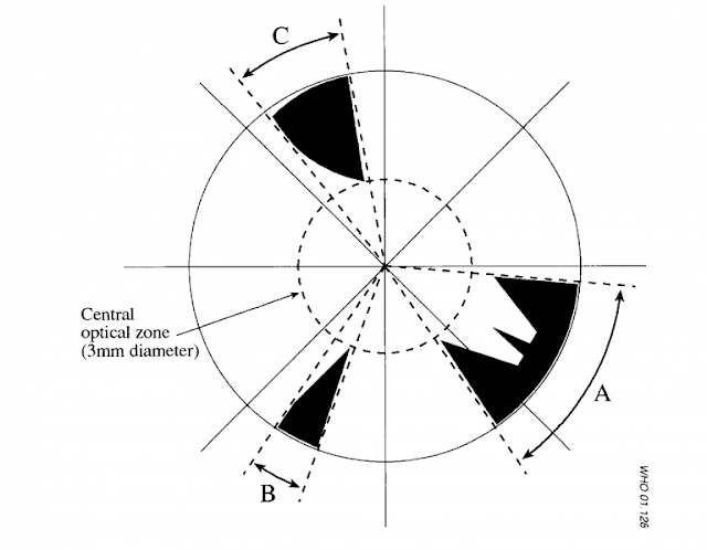 Ophthalmology Notes: Cataract Grading WHO 2002
