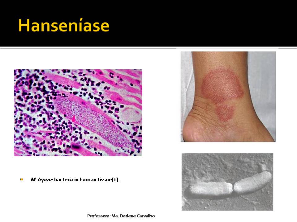 BIOLOGANDO : Doenças bacterianas: hanseníase