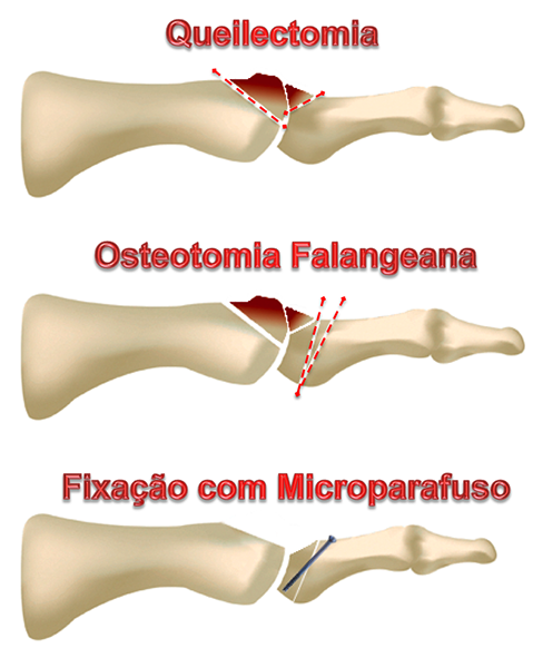 Clínica e Cirurgia do Pé e Tornozelo: Hallux Rigidus