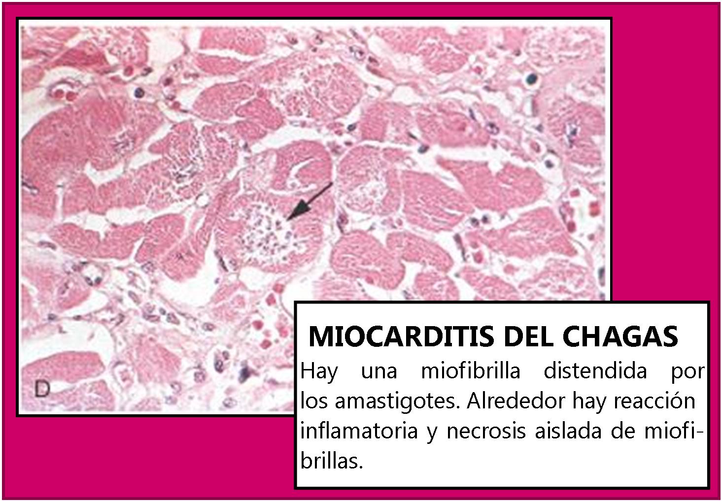 cugatpatologiab: Chagas