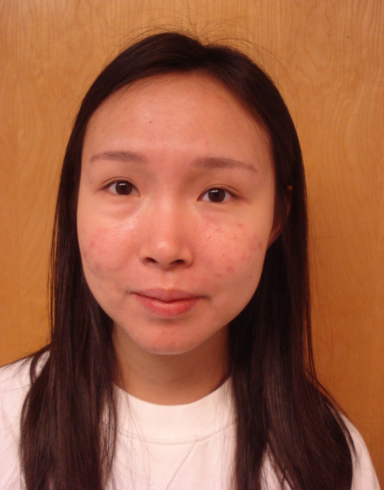 VIRTUAL GRAND ROUNDS IN DERMATOLOGY 2.0: Florid Acneiform Eruption