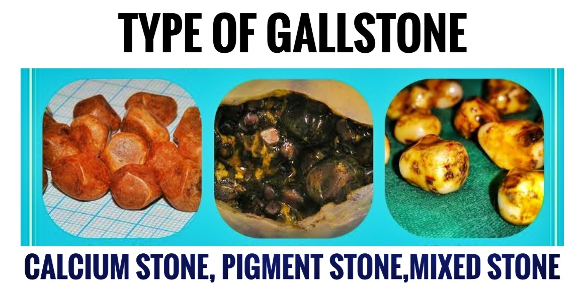 Gallstone: Cause, Diagnosis- Digitaldairies360