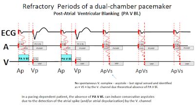 Dr Han Naung @ Henry Han : Electrophysiology and Heart Rhythm : AV ...