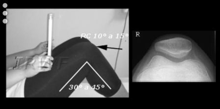 Joelho- Patela Tangencial