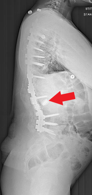 Vertebral Column Resection (VCR) in Pediatric Spinal Deformity Part 3 ...