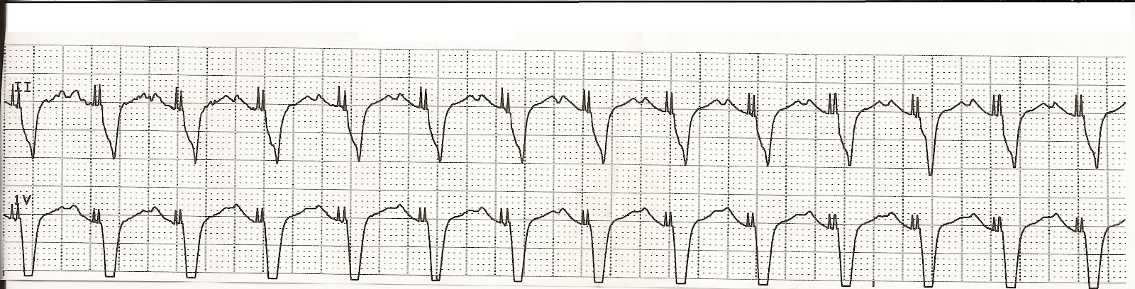 EKG Rhythm Strip Quiz 14