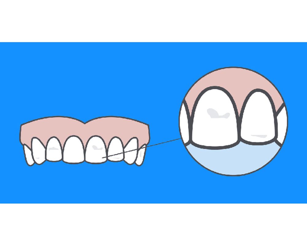 ¿Qué son las manchas blancas? ¿Por qué aparecen? - OdontoVida