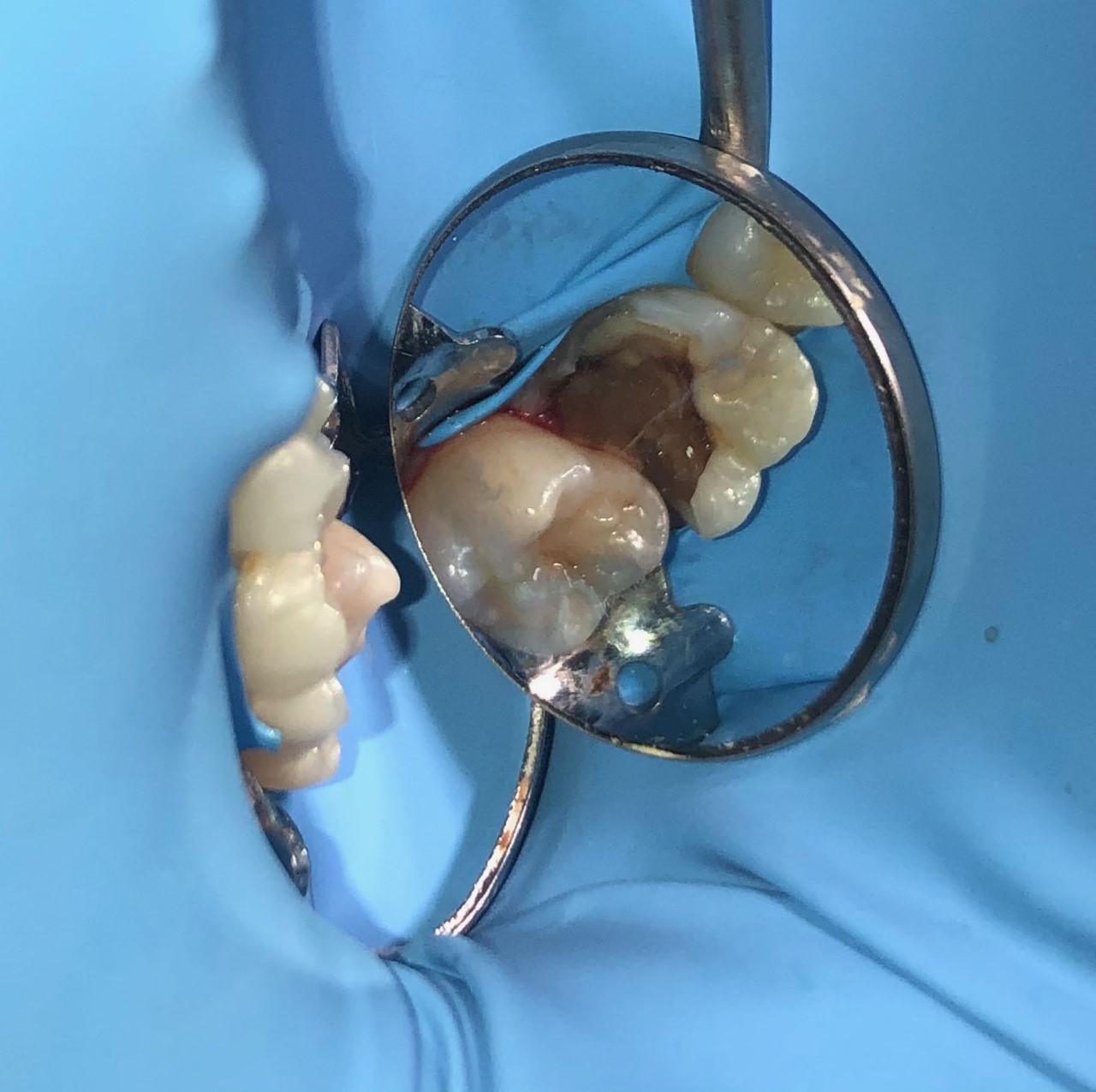 Caso Clínico Máster: Necropulpectomía 26