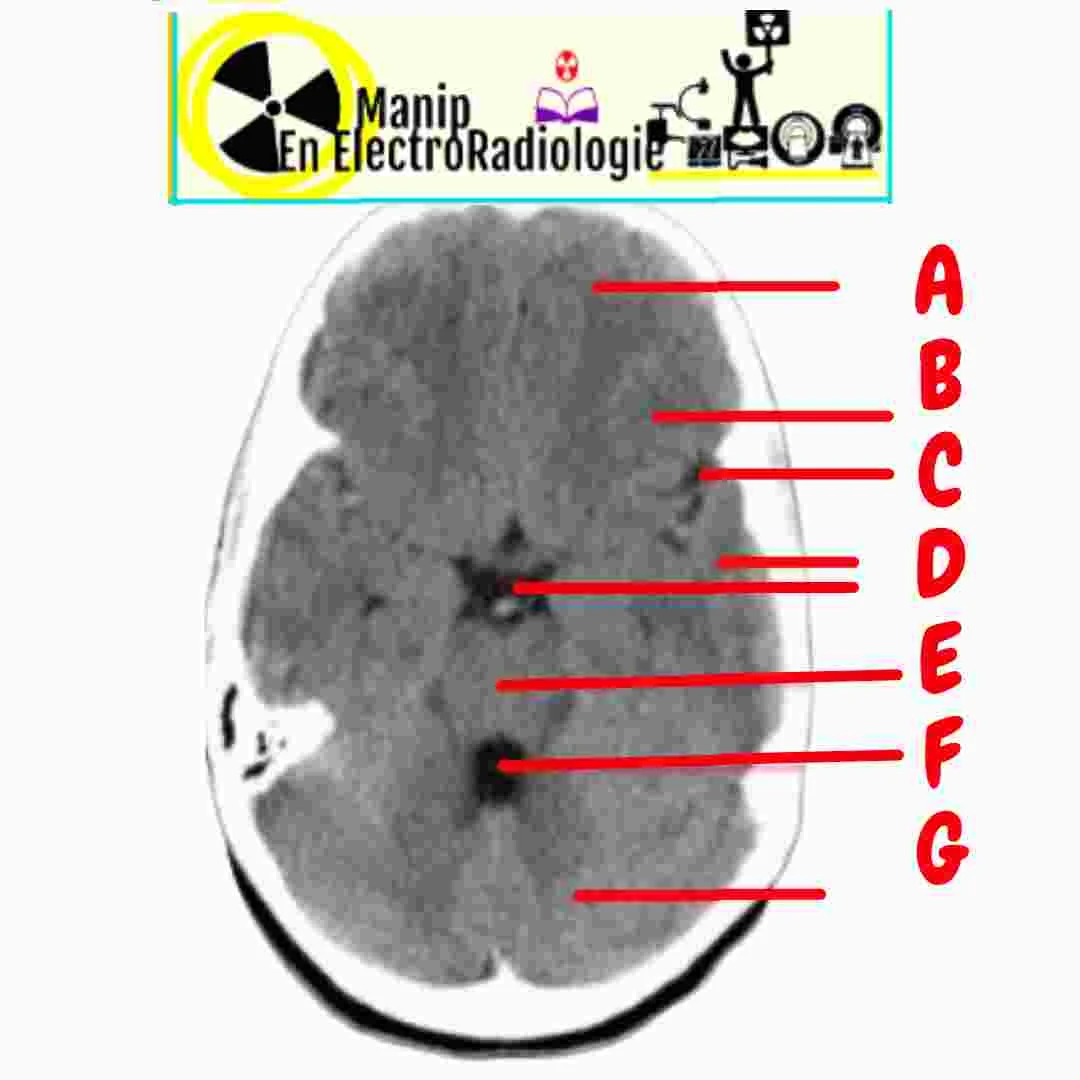 TDM CEREBRALE SCANNR CEREBRAL