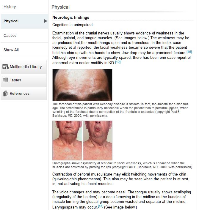 Living with Kennedy's Disease: Another Online Resource on Kennedy’s Disease