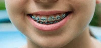 4 Tips Sebelum Pasang Behel - ardyatanjong