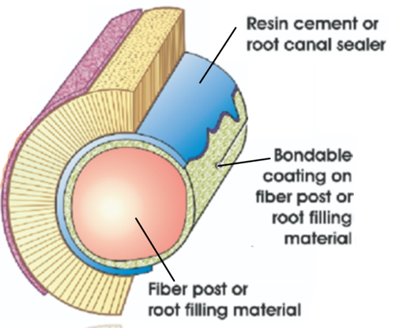 Monoblock in Endodontics [Detailed Explaination with Studies]