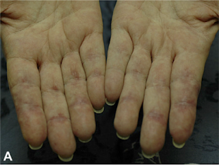 Hospitalist ~なんでも無い科医の勉強ノート~: 逆ゴットロン徴候: Inverse Gottron's sign/papule