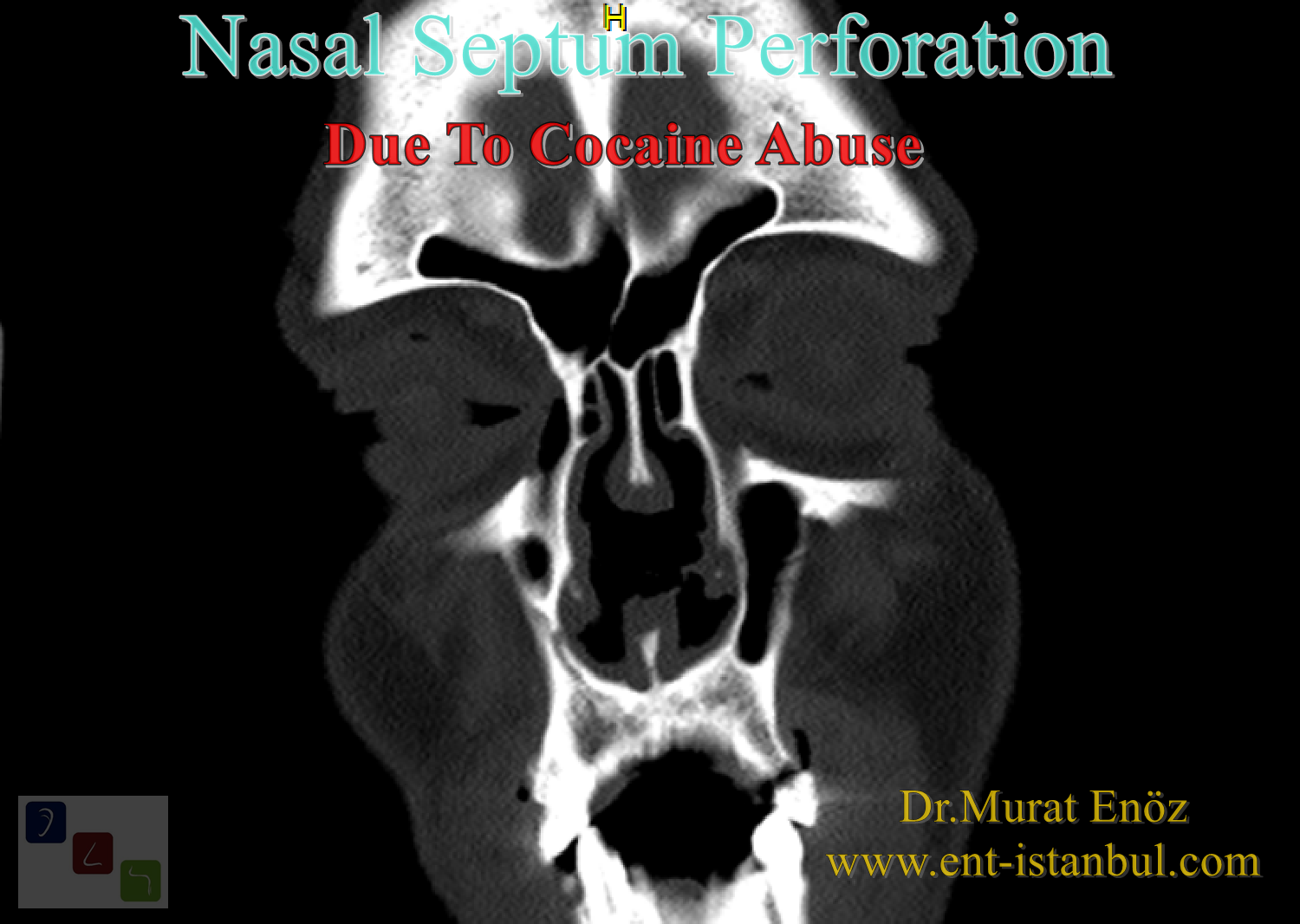 Health Zone Turkey: Symptoms, Causes and Diagnosis of Nasal Septum ...