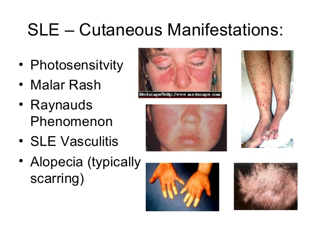 ASK About Vitamins: #Systemic #Lupus #Erythematosus #Serracor #Nattokinase